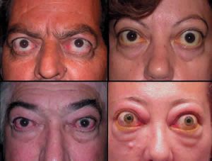 Entendiendo la Enfermedad de Graves-Basedow: Síntomas y Tratamiento ...